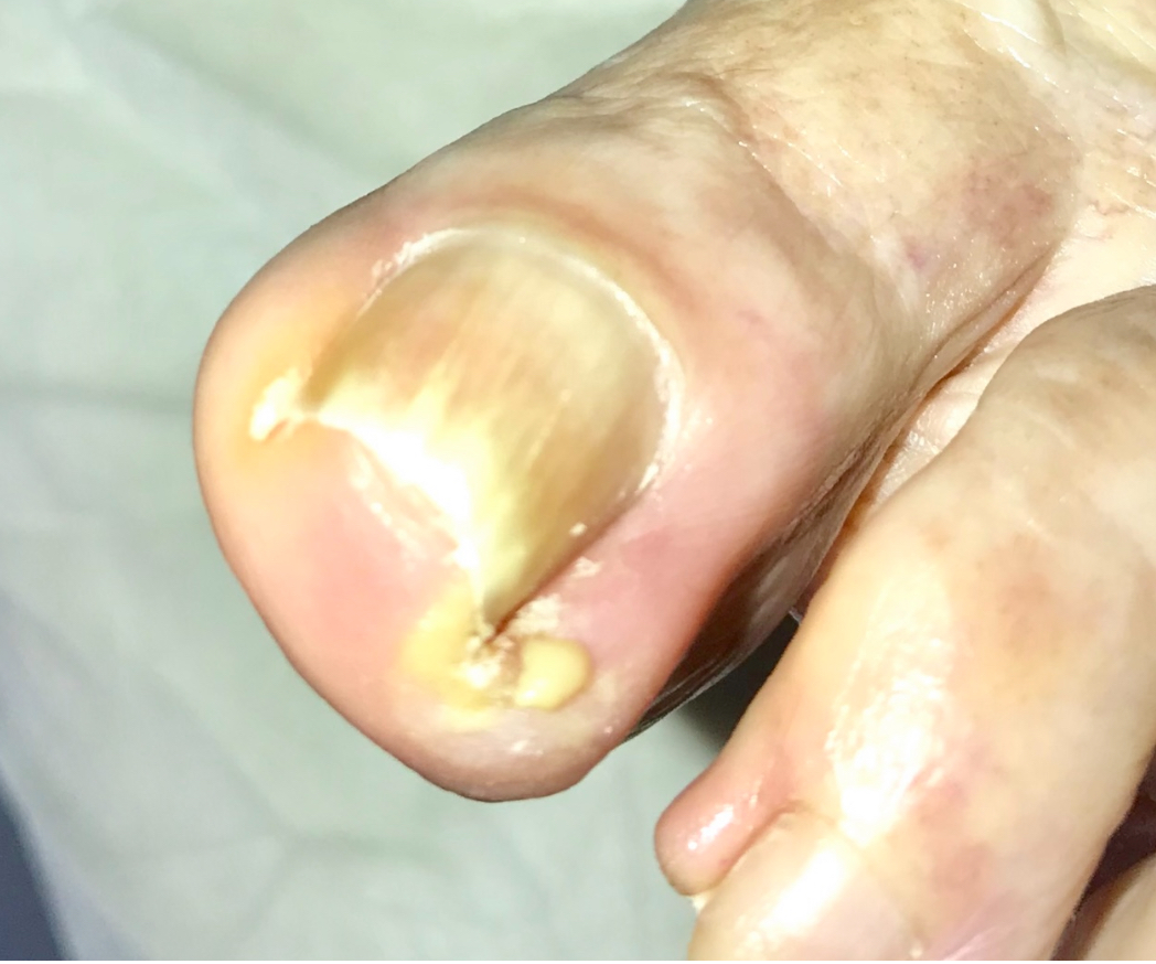 ¿Qué son las Uñas Encarnadas y cómo se tratan? | FeetMedic