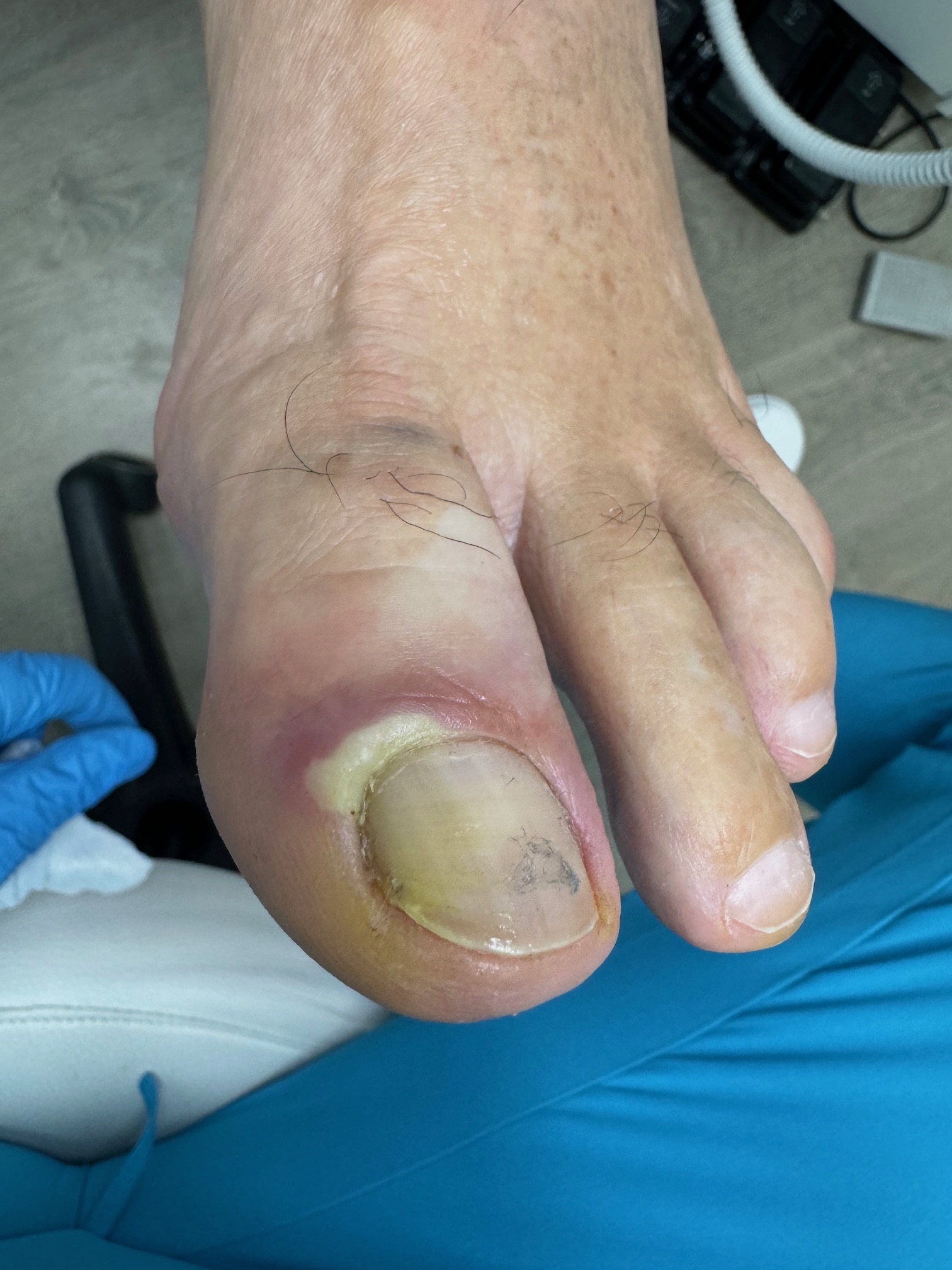 ¿Qué son las Uñas Encarnadas y cómo se tratan? | FeetMedic