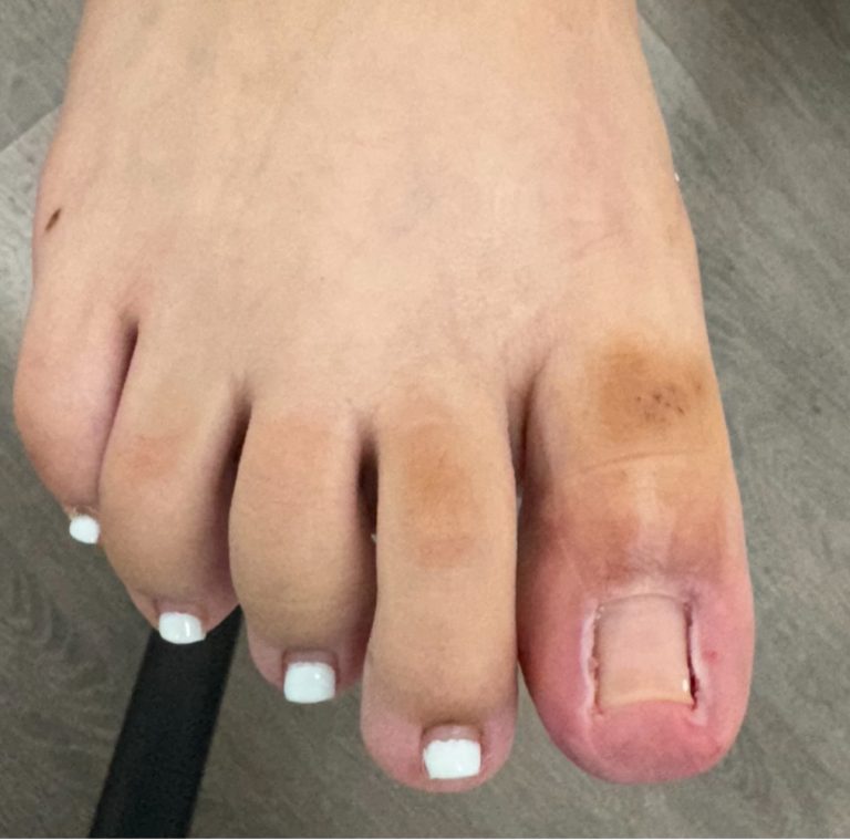 Diagnóstico y Tratamiento de La Uña Encarnada | FeetMedic