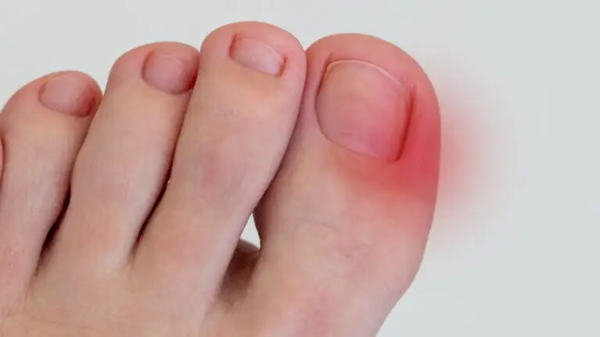 Diagnóstico y Tratamiento de La Uña Encarnada | FeetMedic