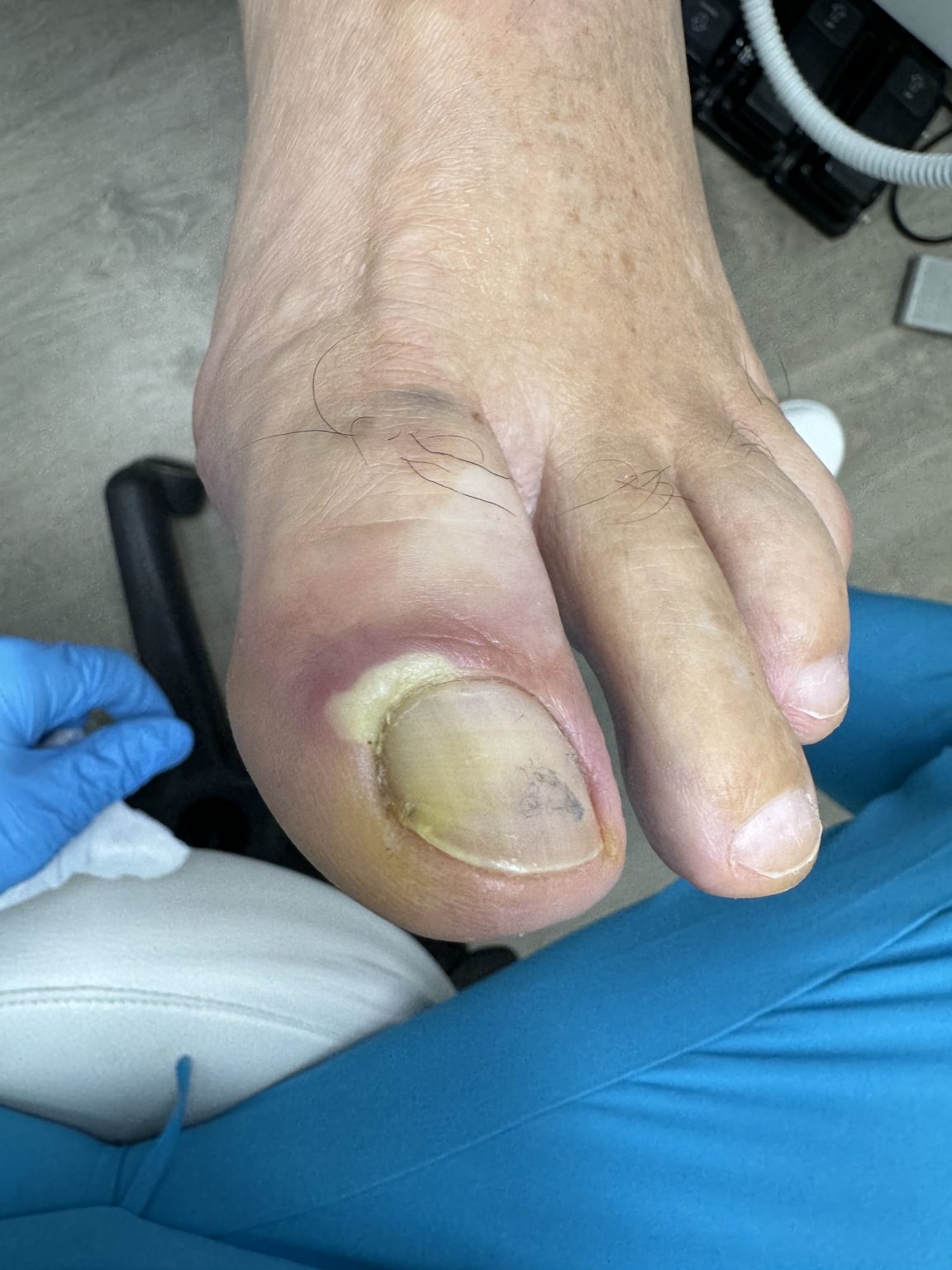 Diagnóstico y Tratamiento de La Uña Encarnada | FeetMedic